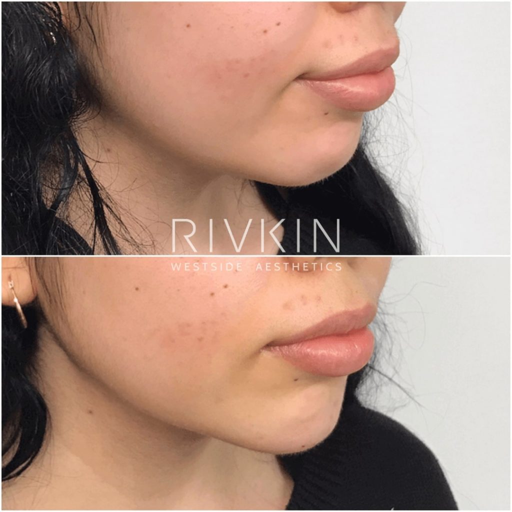 Chin - RIVKIN Aesthetics