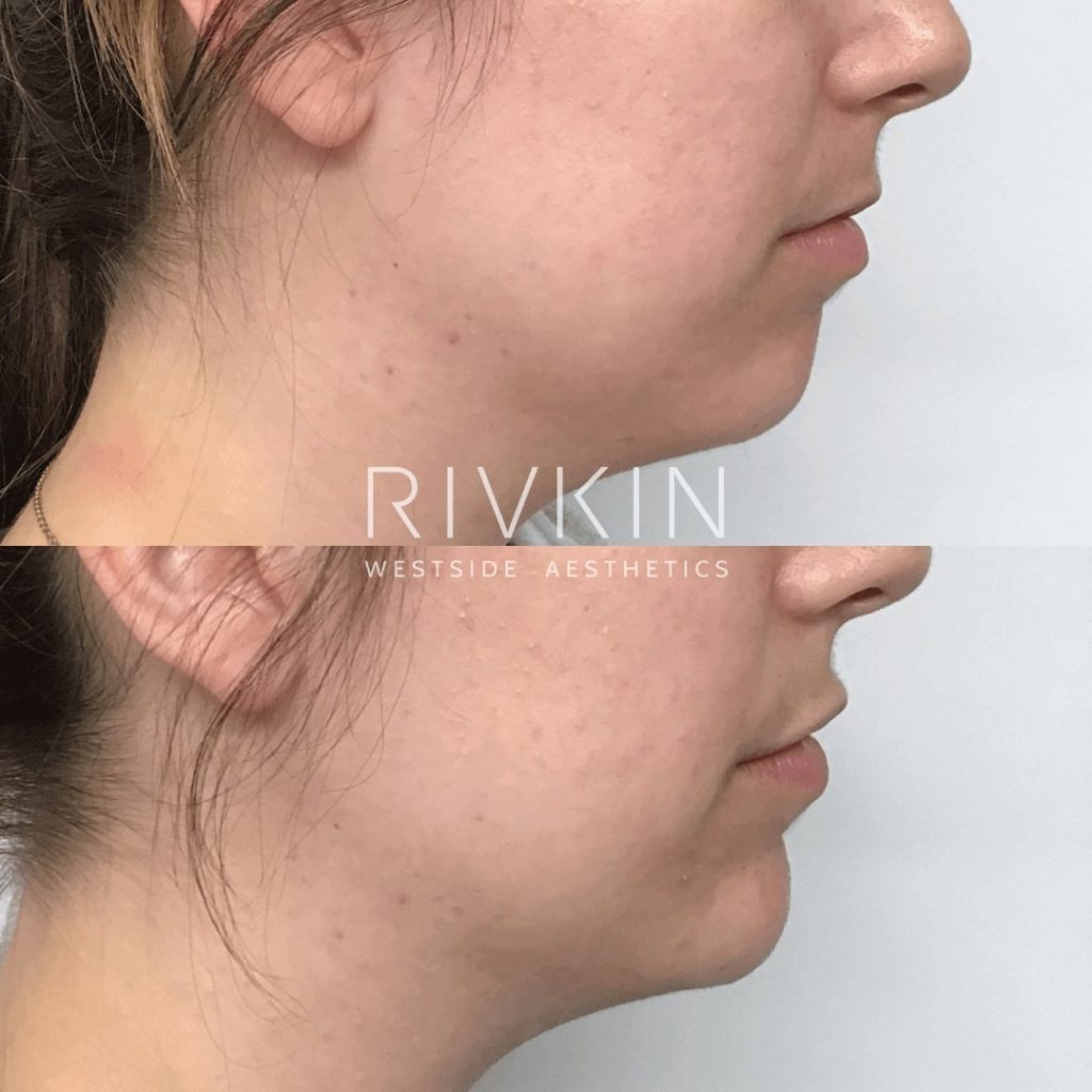 Chin - RIVKIN Aesthetics