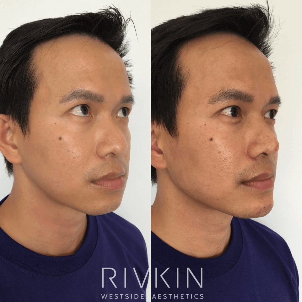 Jawline - RIVKIN Aesthetics