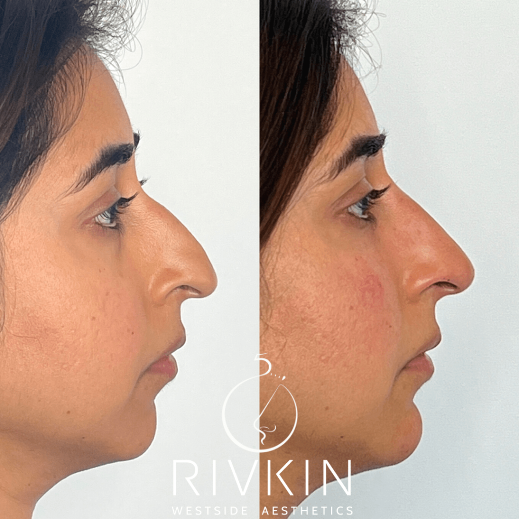 Chin - RIVKIN Aesthetics