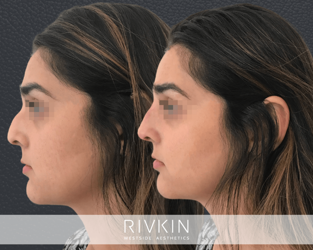 Droopy Tip - RIVKIN Aesthetics