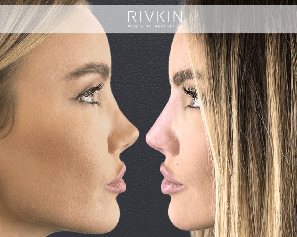 Revision Rhinoplasty - RIVKIN Aesthetics