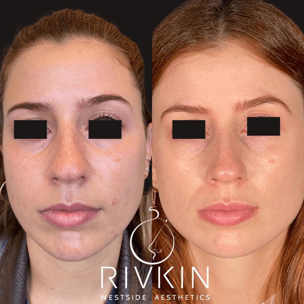 Tip Correction - RIVKIN Aesthetics